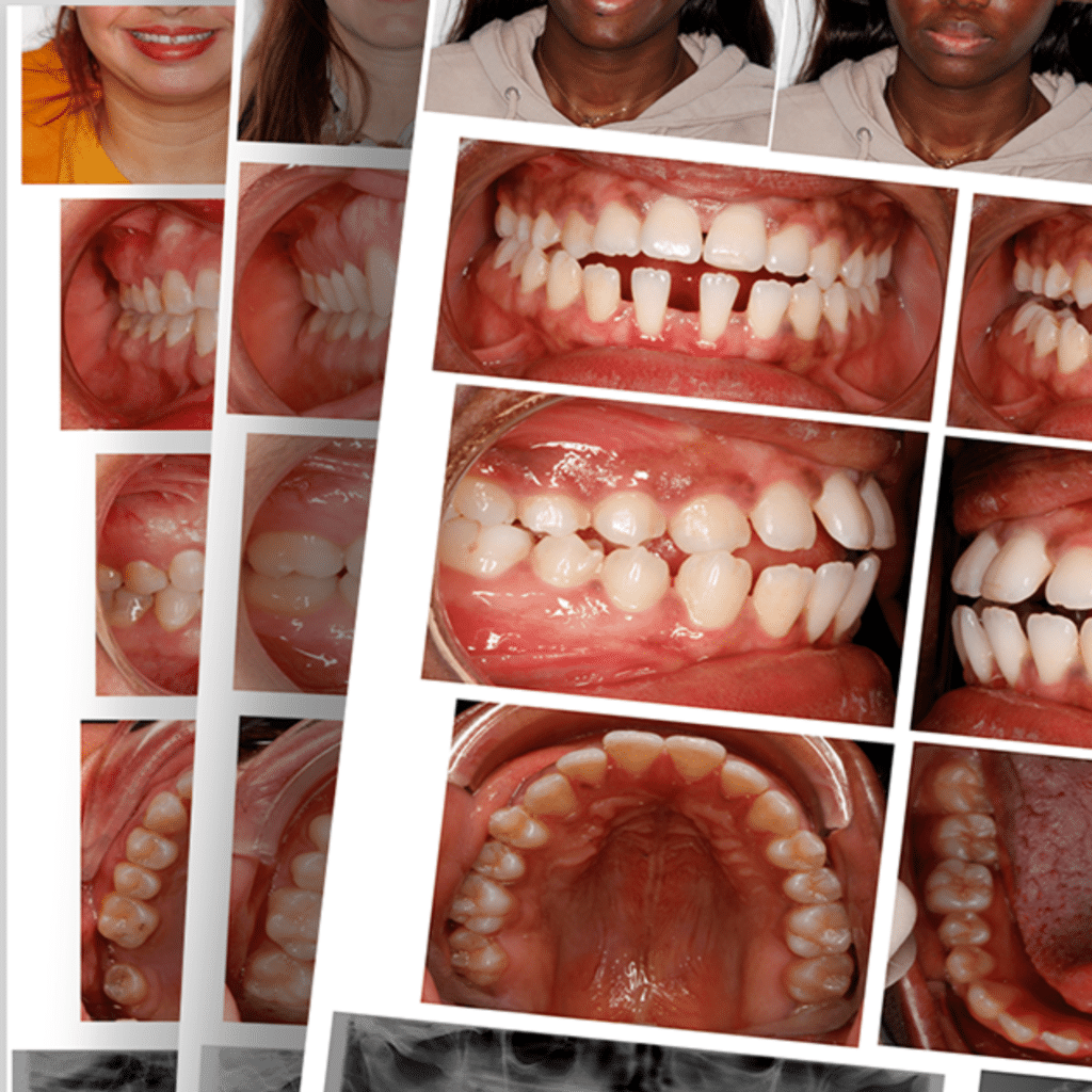 Logiciel d'orthodontie par aligneurs I Aligneurs Français